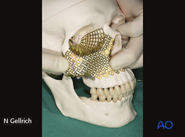 Midface reconstruction