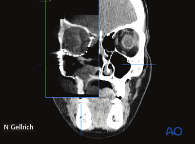 Midface reconstruction