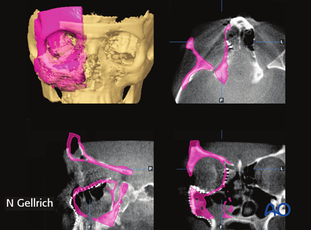 Midface reconstruction