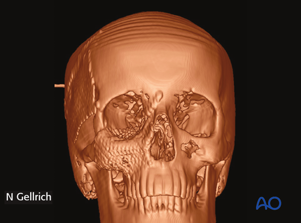 Midface reconstruction