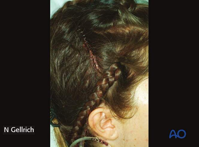 Midface reconstruction