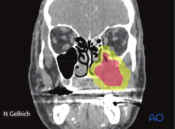 Biopsy mapping