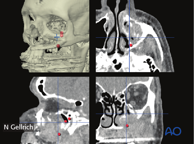 Biopsy mapping