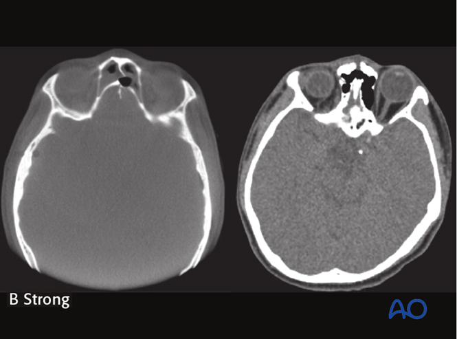 Cone beam vs. fan beam CT