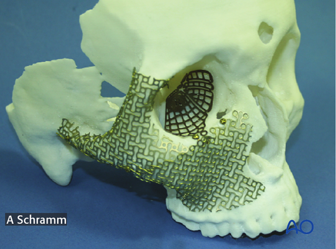 Computer assisted surgery