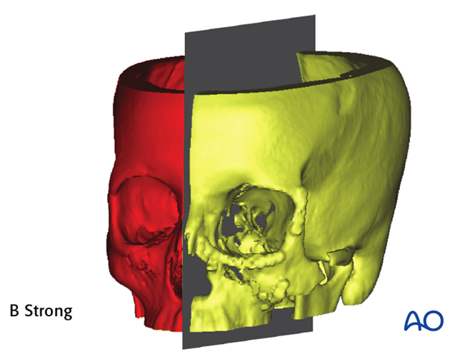 Computer assisted surgery