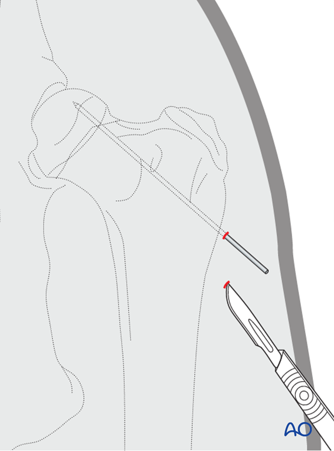 Parallel K-wires for Simple transcervical