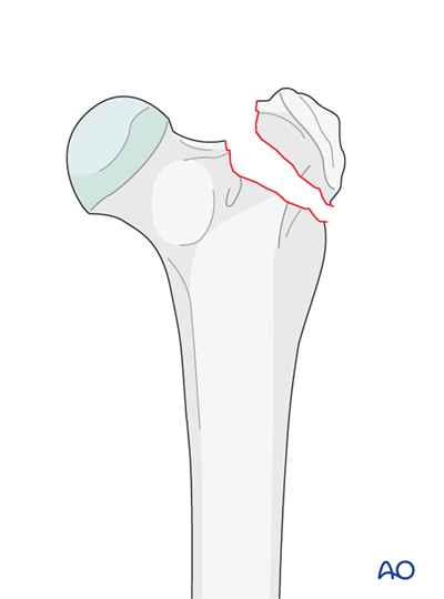 Trochanteric avulsion