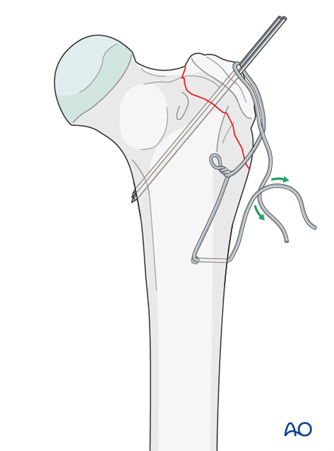 Tension band for Trochanteric region, avulsion