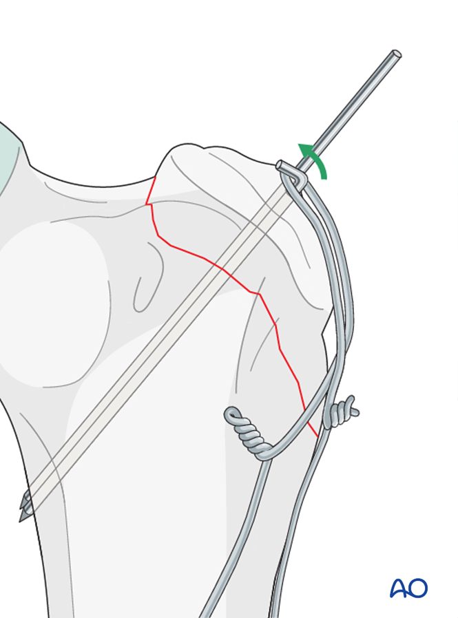 Tension band for Trochanteric region, avulsion