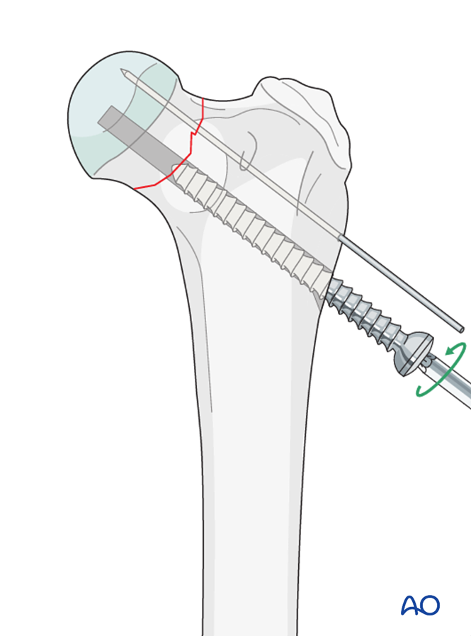 Lag screw and K-wire for Simple transcervical
