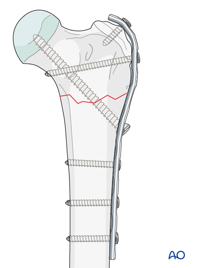 Plate fixation for Trochanteric region, intertrochanteric simple