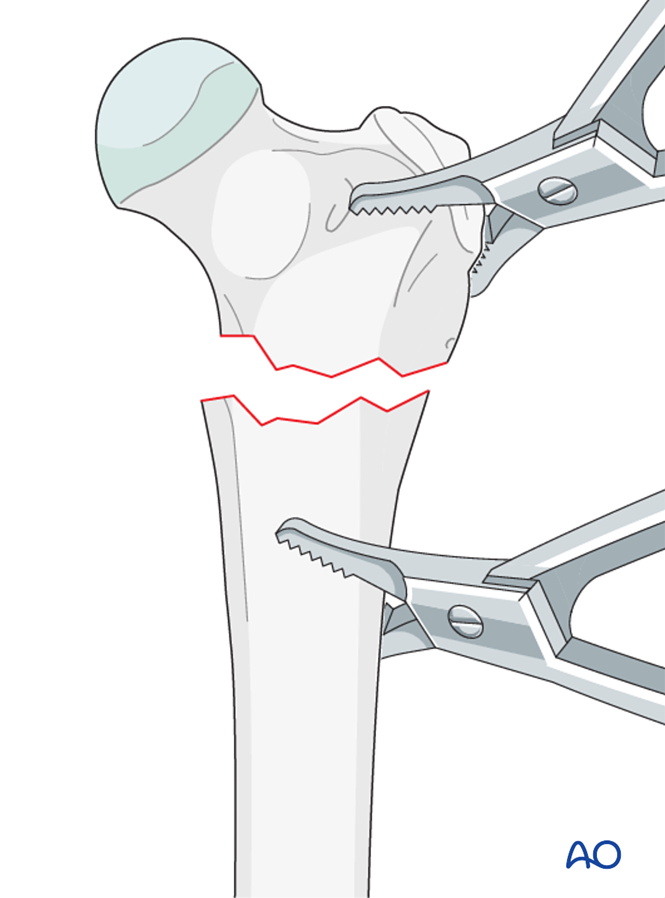 Plate fixation for Trochanteric region, intertrochanteric simple