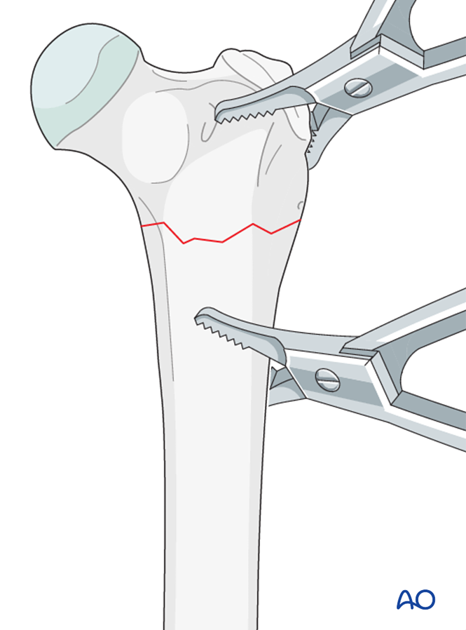 Plate fixation for Trochanteric region, intertrochanteric simple