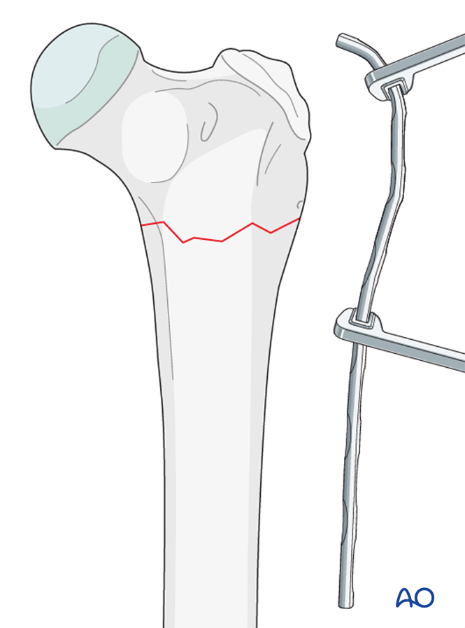 Plate fixation for Trochanteric region, intertrochanteric simple