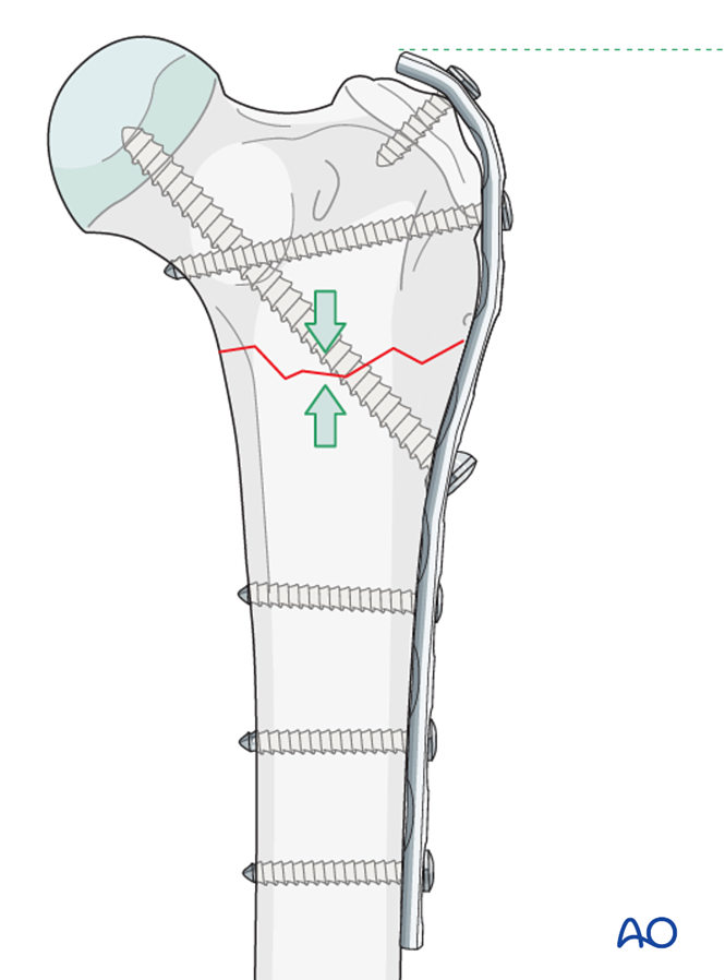 Plate fixation for Trochanteric region, intertrochanteric simple