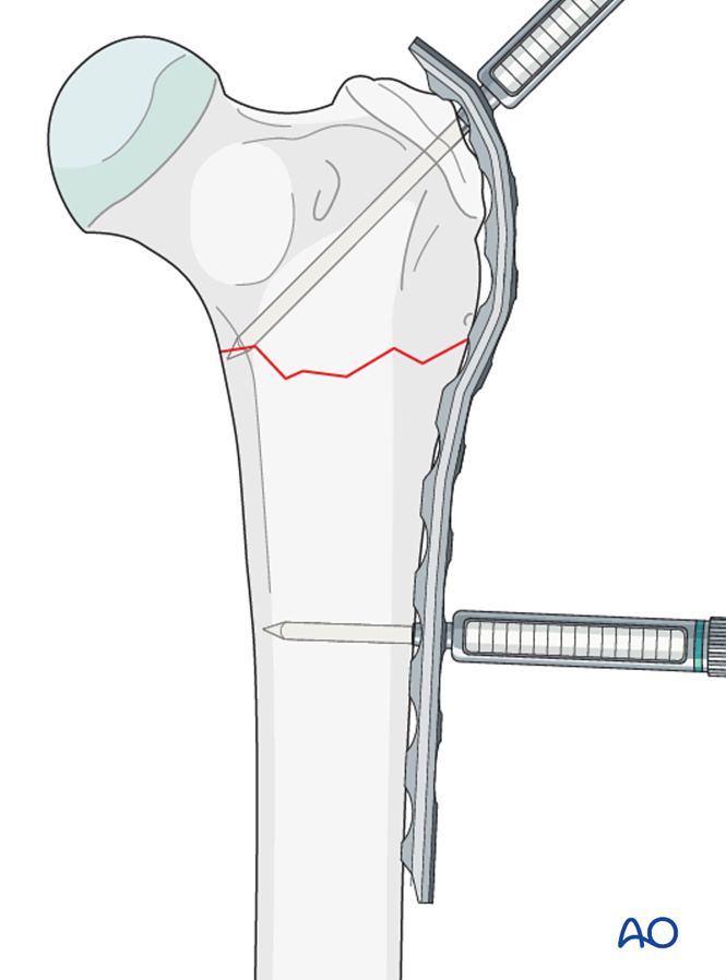 Plate fixation for Trochanteric region, intertrochanteric simple