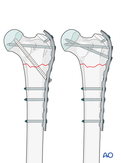 Plate fixation for Trochanteric region, intertrochanteric simple
