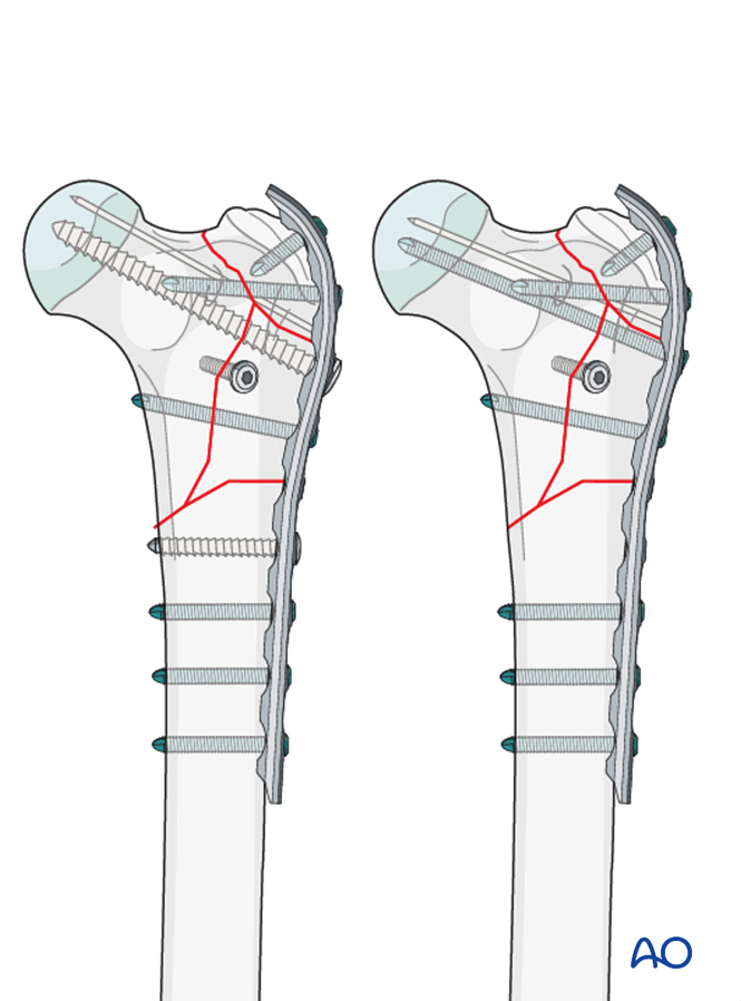 Plate fixation with lag screws and pins for Trochanteric region ...