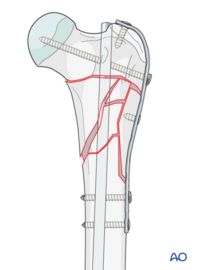 Plate and rod for Trochanteric region, multifragmentary