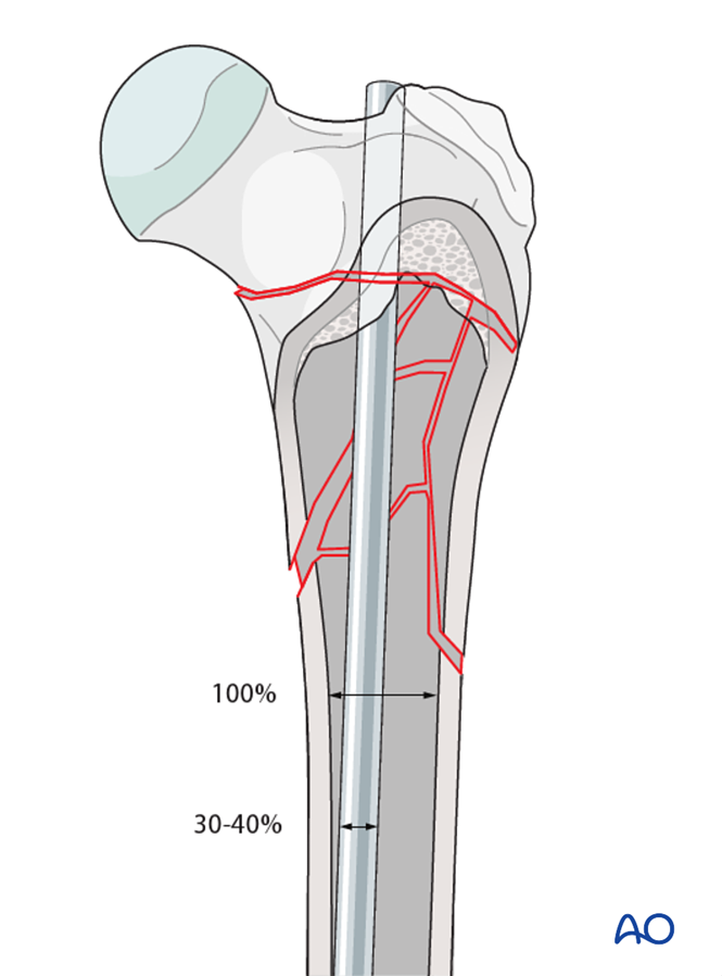 Plate and rod for Trochanteric region, multifragmentary