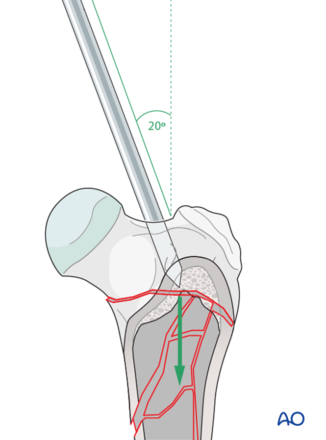 Tie-in technique for Trochanteric region, multifragmentary