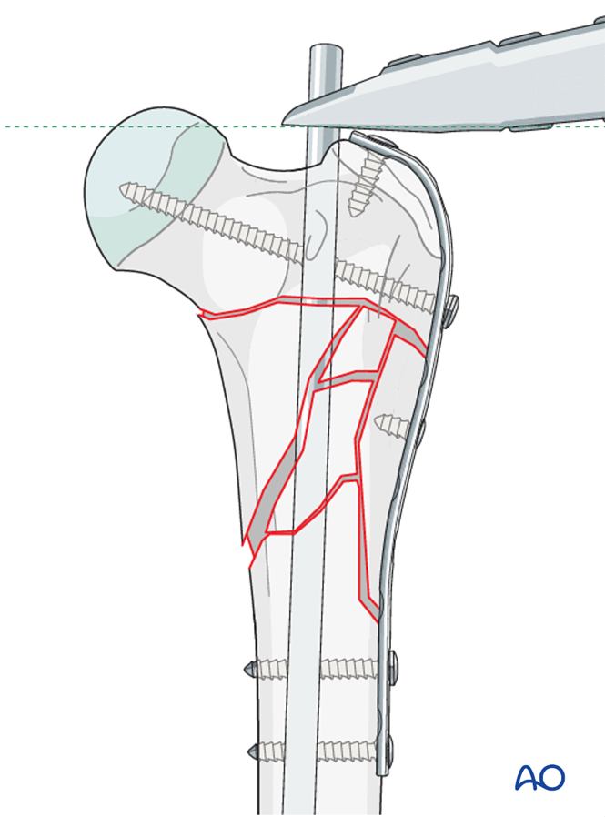 Plate and rod for Trochanteric region, multifragmentary