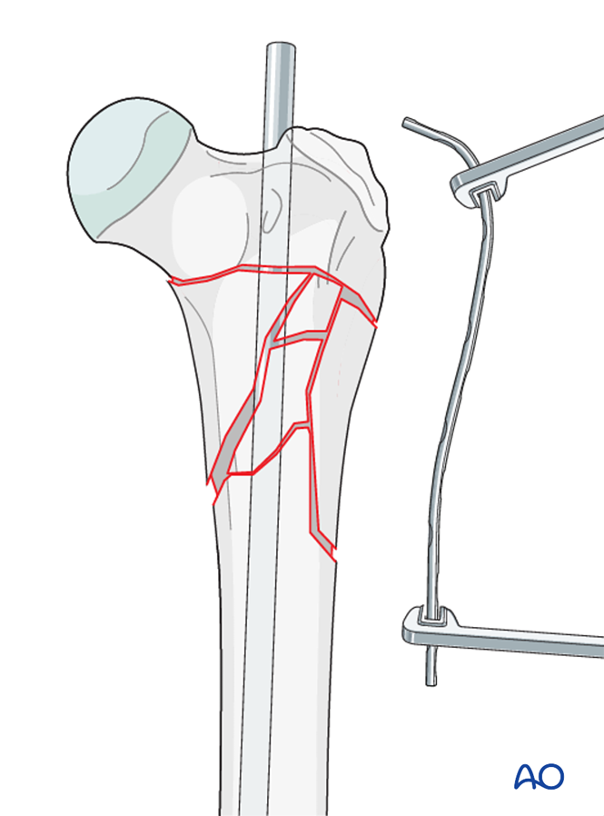Plate and rod for Trochanteric region, multifragmentary