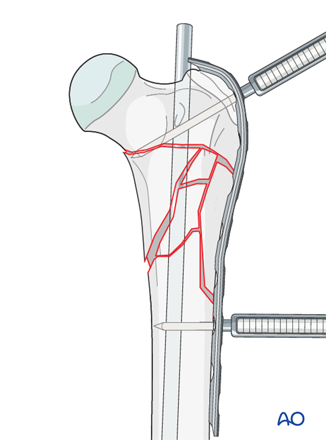 Plate and rod for Trochanteric region, multifragmentary