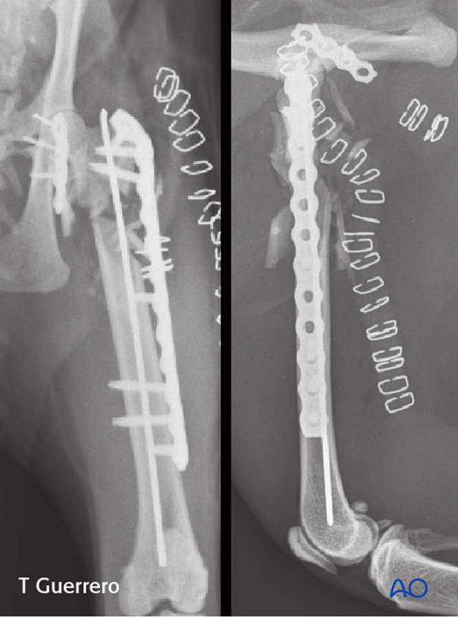 Plate and rod for Trochanteric region, multifragmentary