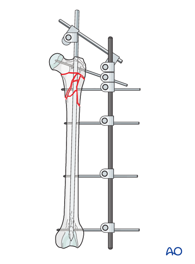 Tie-in technique for Trochanteric region, multifragmentary