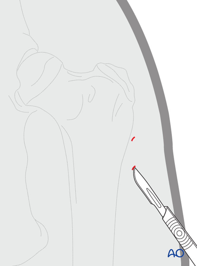 Tie-in technique for Trochanteric region, multifragmentary