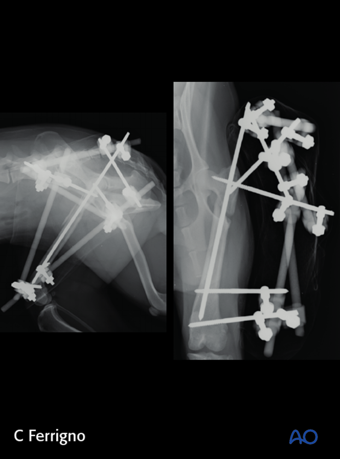 Tie-in technique for Trochanteric region, multifragmentary
