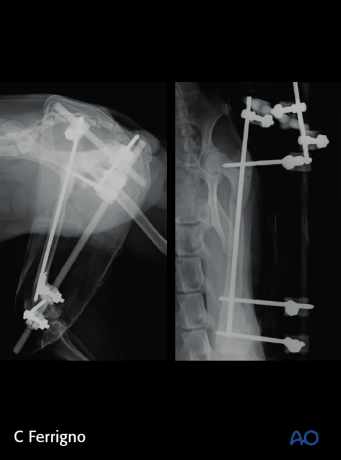 Tie-in technique for Trochanteric region, multifragmentary