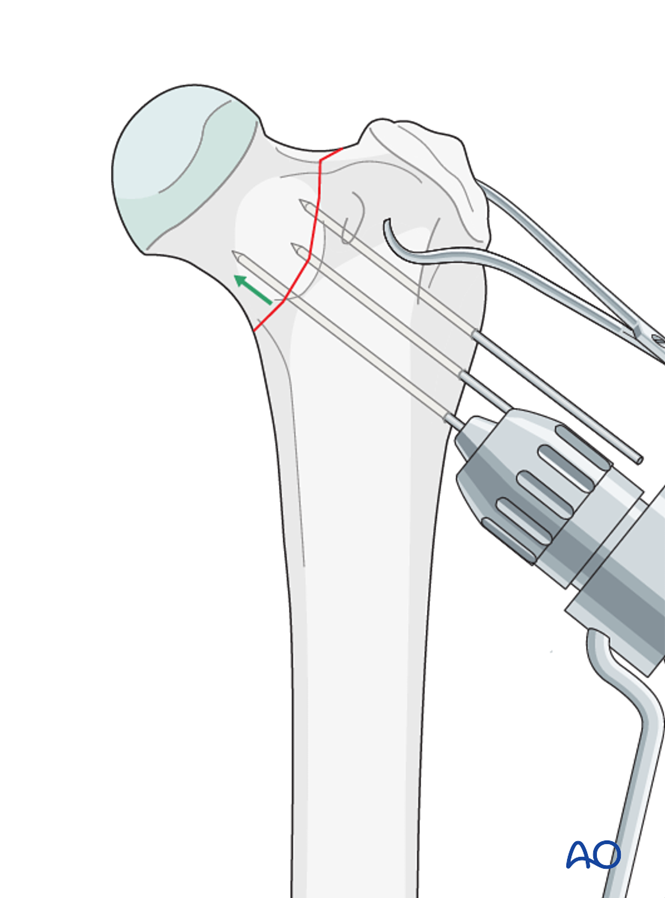 Parallel K-wires for Simple basicervical