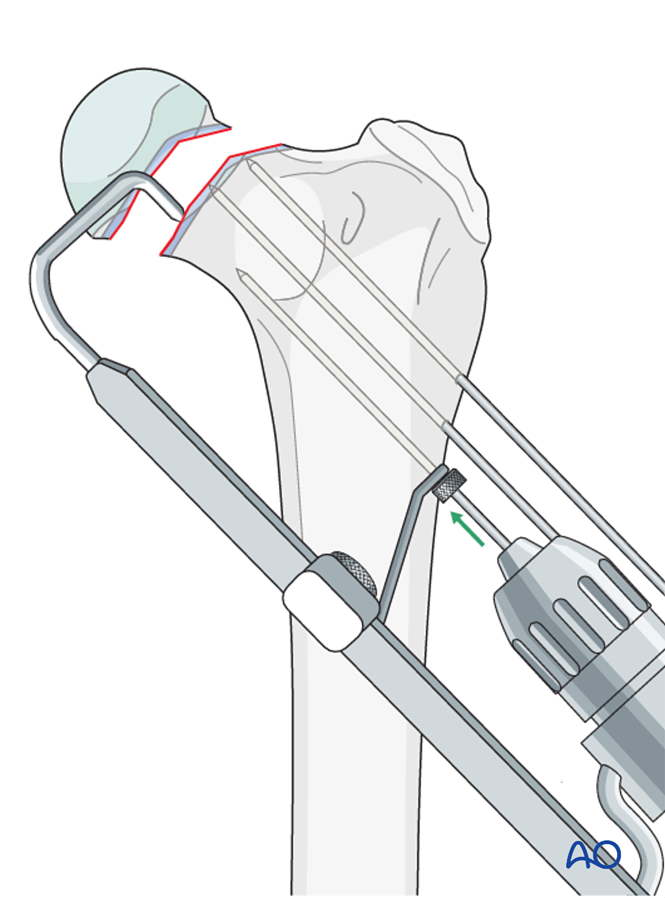 Parallel K-wires for Simple transcervical