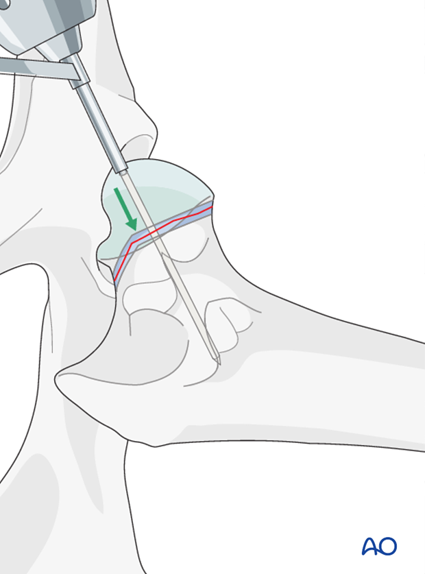 Parallel K-wires for Simple transcervical