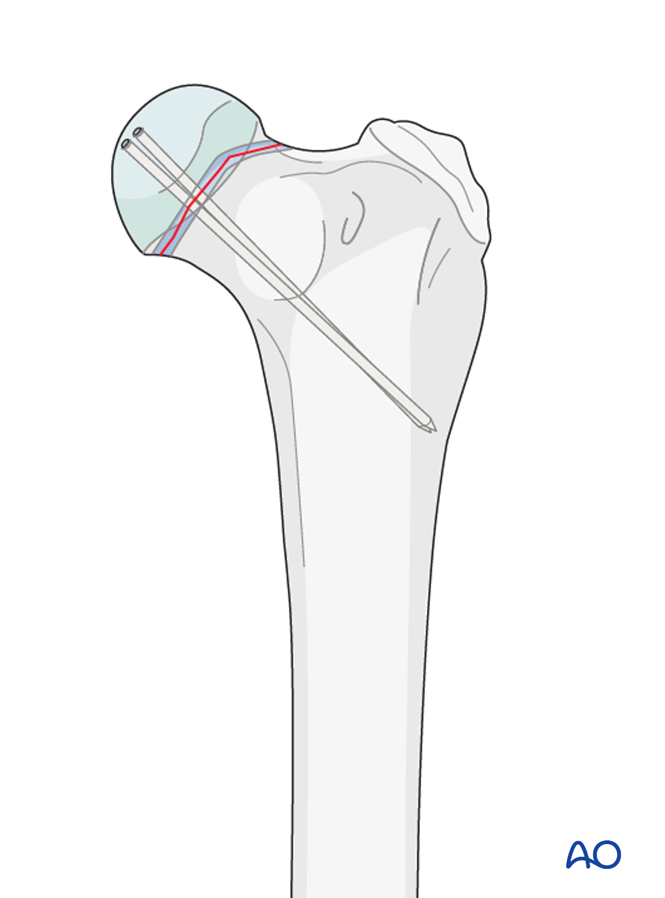 Parallel K-wires for Simple transcervical