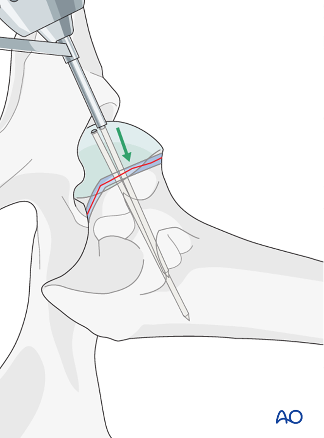 Parallel K-wires for Simple transcervical