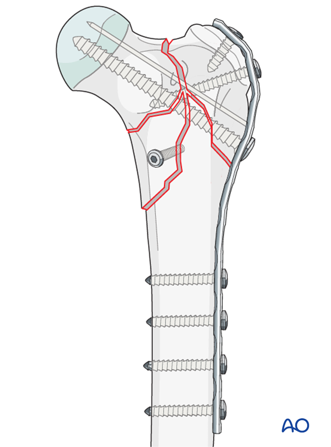 Plate and lag screw fixation for Multifragmentary cervical and trochanteric