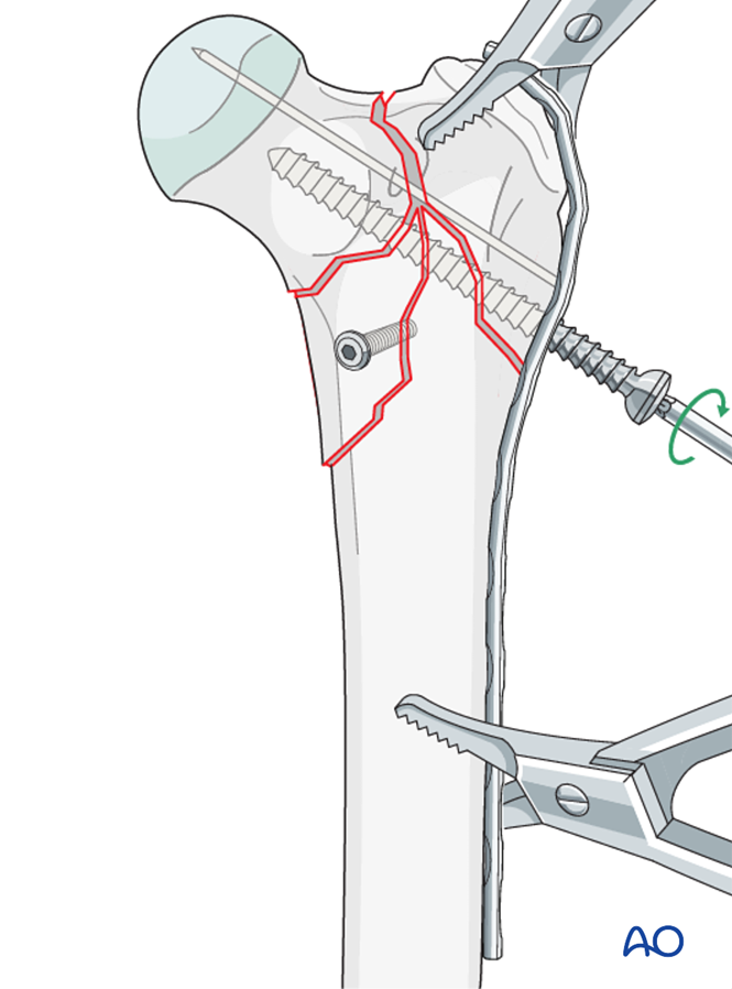 Plate and lag screw fixation for Multifragmentary cervical and trochanteric