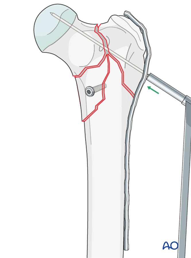 Plate and lag screw fixation for Multifragmentary cervical and trochanteric