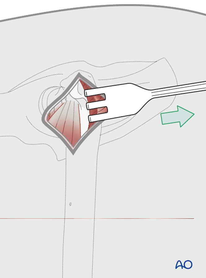 Approaches for minimally invasive osteosynthesis (MIO) to the cat ...