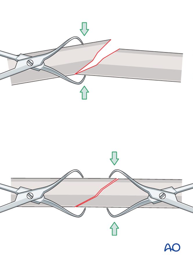 Intramedullary pin fixation with cerclage wires for Simple oblique ...