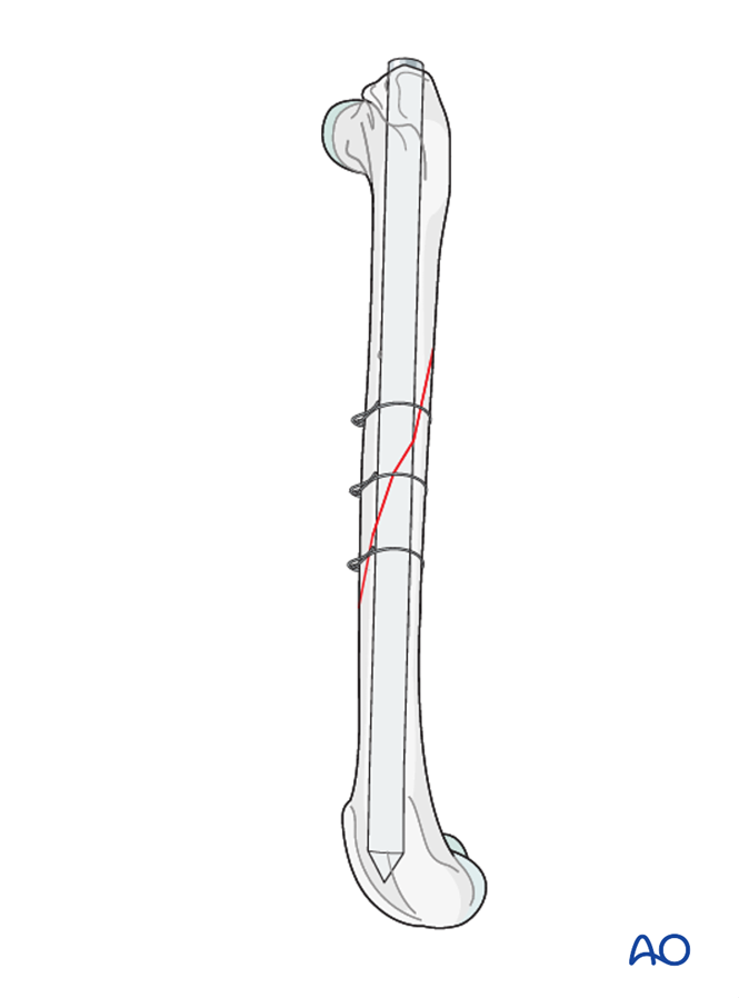 Intramedullary pin fixation with cerclage wires for Simple oblique ...