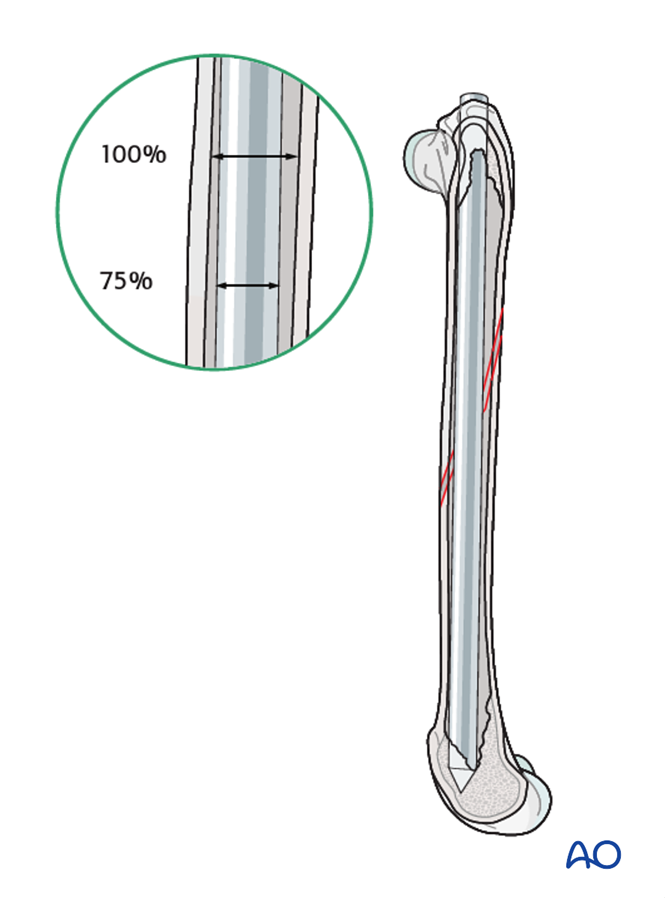 Intramedullary pin fixation with cerclage wires for Simple oblique ...