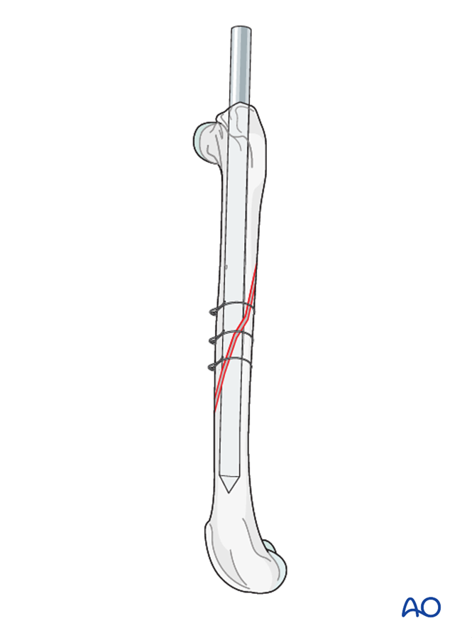 Intramedullary pin fixation with cerclage wires for Simple oblique ...