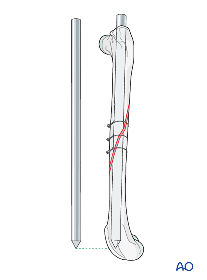 Intramedullary pin fixation with cerclage wires for Simple oblique ...