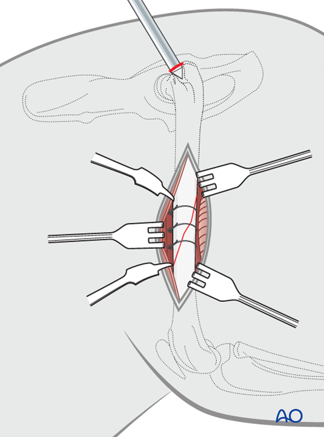 Intramedullary pin fixation with cerclage wires for Simple oblique ...