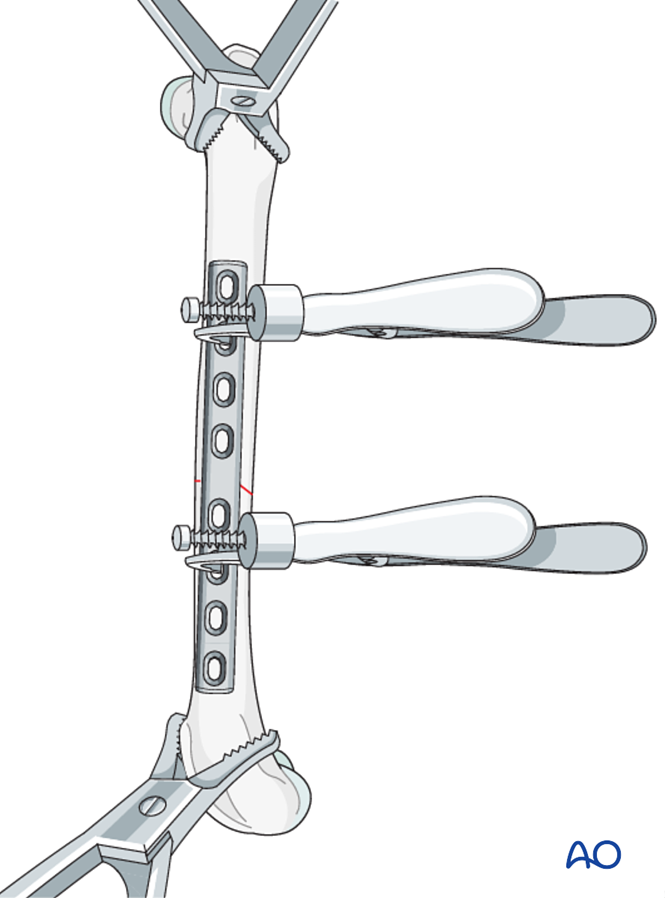 Compression plate for Simple transverse fractures of the femoral diaphysis
